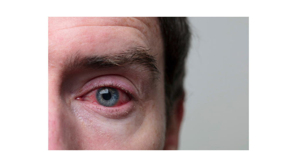 Itchy Eyes | Oklahoma Allergy and Asthma Clinic